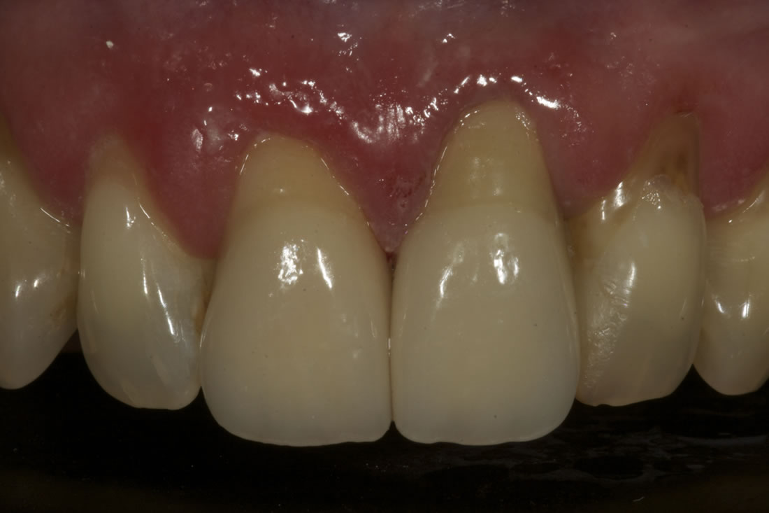 Upper Crowns Changed - Stow on the Wold Dental Practice