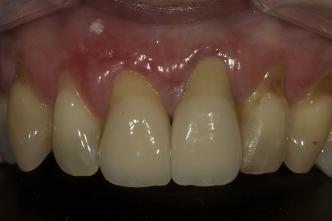 Upper Crowns Changed - Stow on the Wold Dental Practice