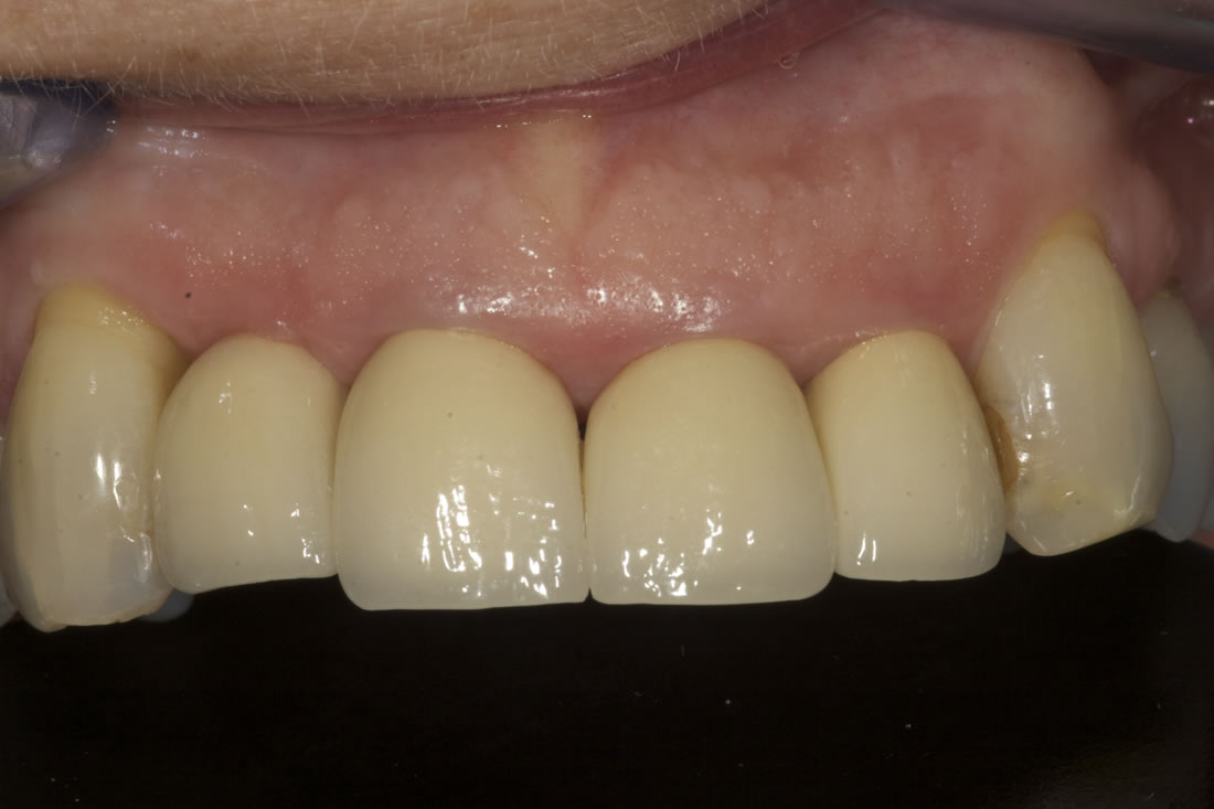 Single Implant & Crowns - Stow on the Wold Dental Practice